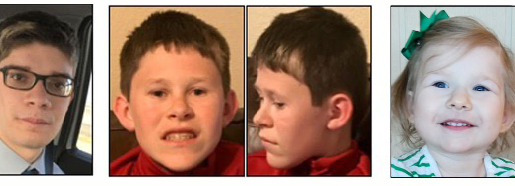 Pitt-Hopkins Syndrome: A Review of Current Literature, Clinical ...